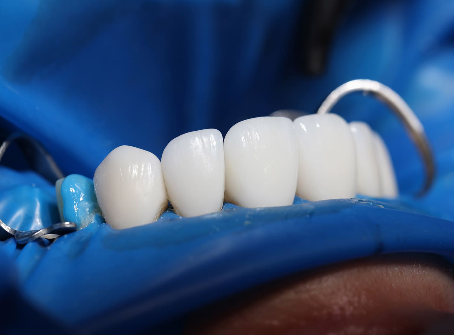 Prosthetic Crowns (Prosthetic Dental Treatment) – Whitedent Dent Clinic