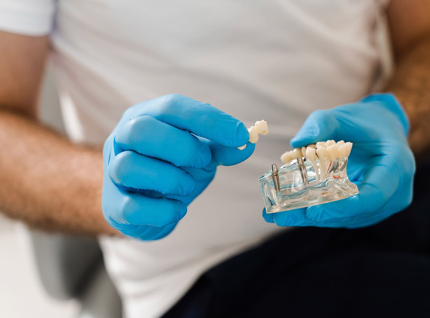 Prosthetic Crowns (Prosthetic Dental Treatment) – Whitedent Dent Clinic