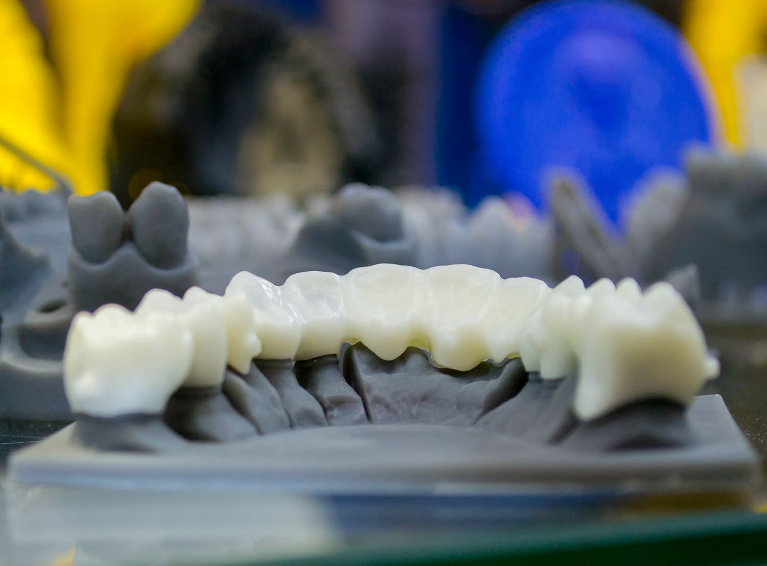 Prosthetic Crowns (Prosthetic Dental Treatment) – Whitedent Dent Clinic