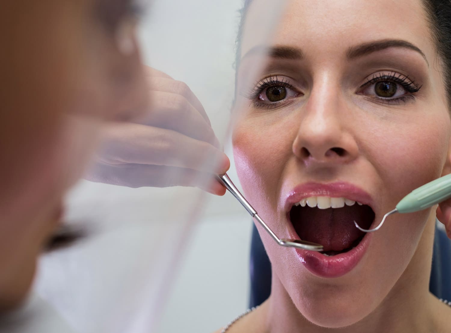 Bonding – Whitedent Dent Clinic