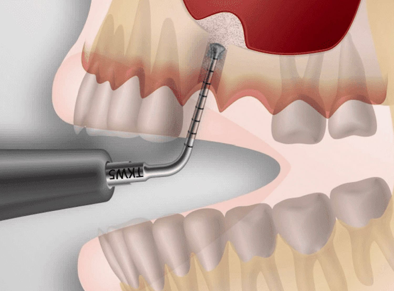What is Sinus Lifting? – Whitedent Dent Clinic